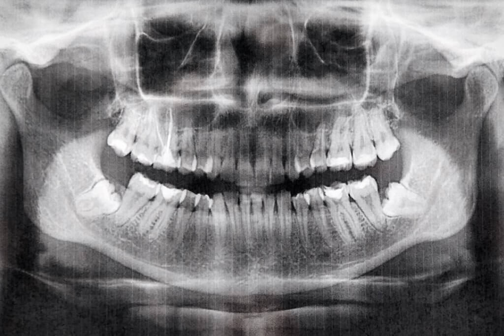 Top Ten Wisdom Teeth Questions Answered